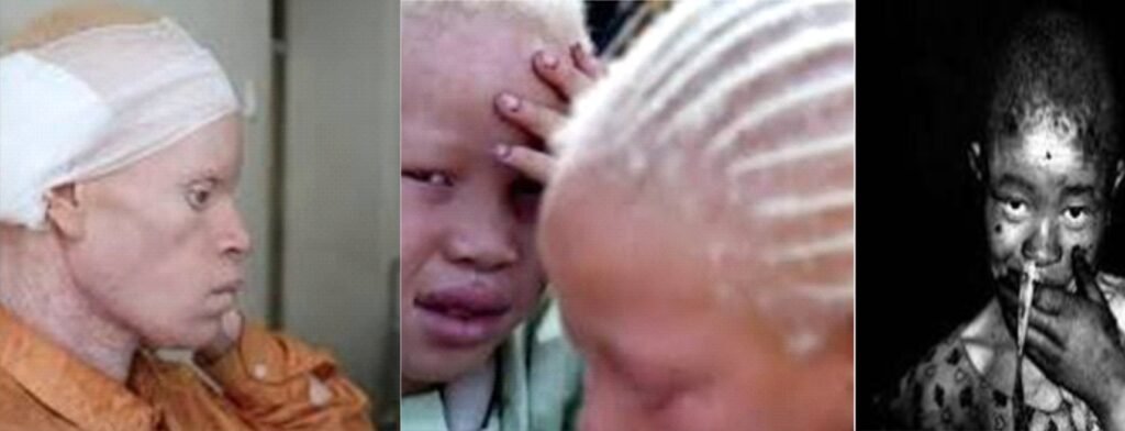 Two albinos die of skin cancer in Nigeria every month – Association ...
